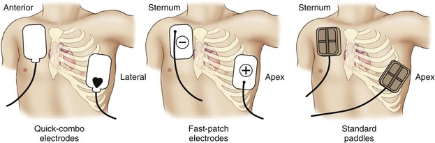 Electrical Therapy Thoracic Key