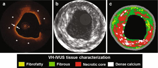 Intracoronary Imaging And Intracoronary Functional Tests Thoracic Key