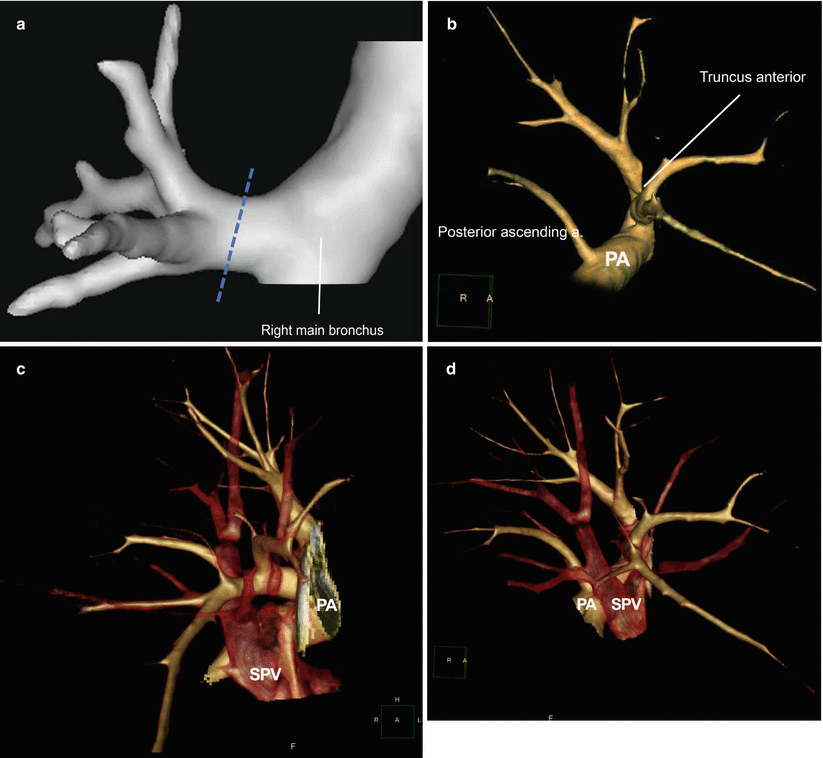 Lobectomy Thoracic Key