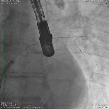 Practical Watchman Implantation Thoracic Key