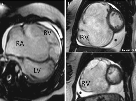 Imaging Of The Tricuspid Valve Magnetic Resonance Imaging Thoracic Key