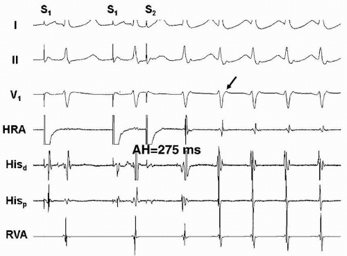 Electrophysiologic Testing Indications And Limitations Thoracic Key