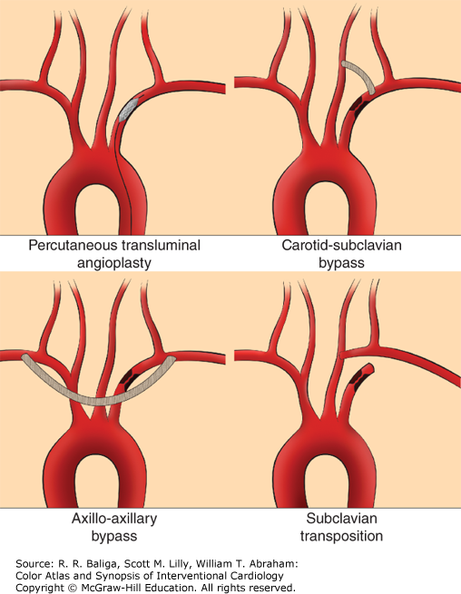 Subclavian Artery Stenosis Thoracic Key