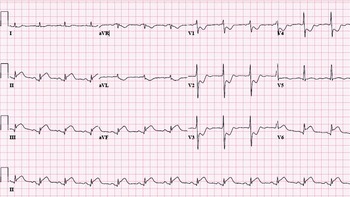 Chapter 4 – Posterior Wall Myocardial Infarction | Thoracic Key