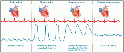 Cardiac Catheterization And Hemodynamic Assessment Thoracic Key